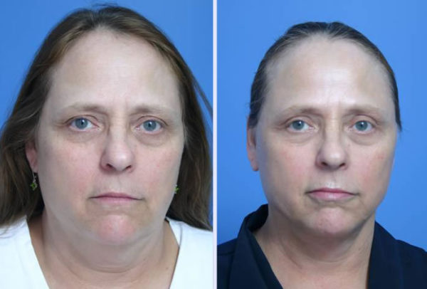 this patient presented with a bottom heavy face. it made her look ...